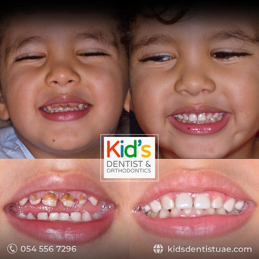 Pediatric Dentist in Dubai - Best Kids Dentist in Dubai - Dr. Suhel ...
