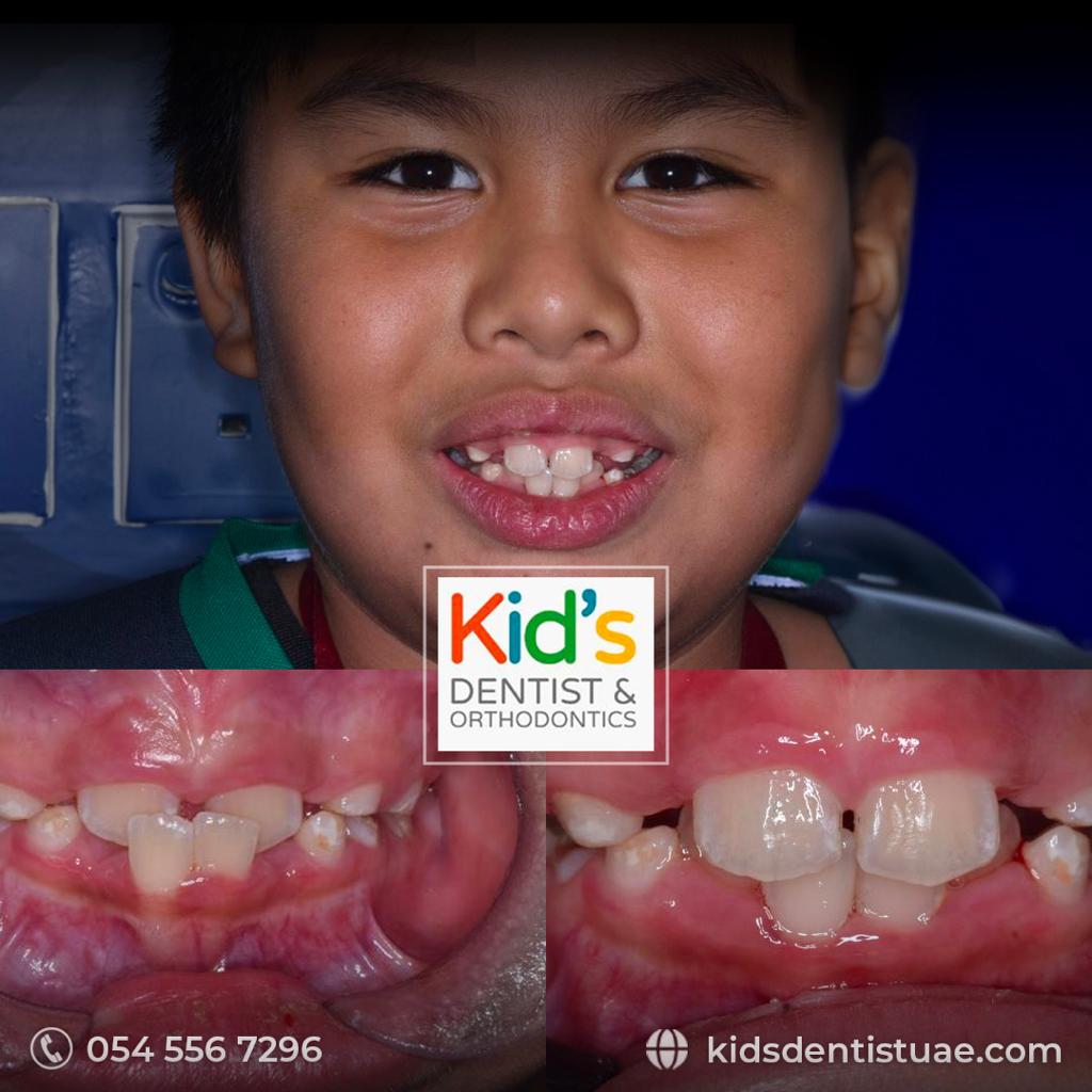 Pediatric Dentist in Dubai - Best Kids Dentist in Dubai - Dr. Suhel ...