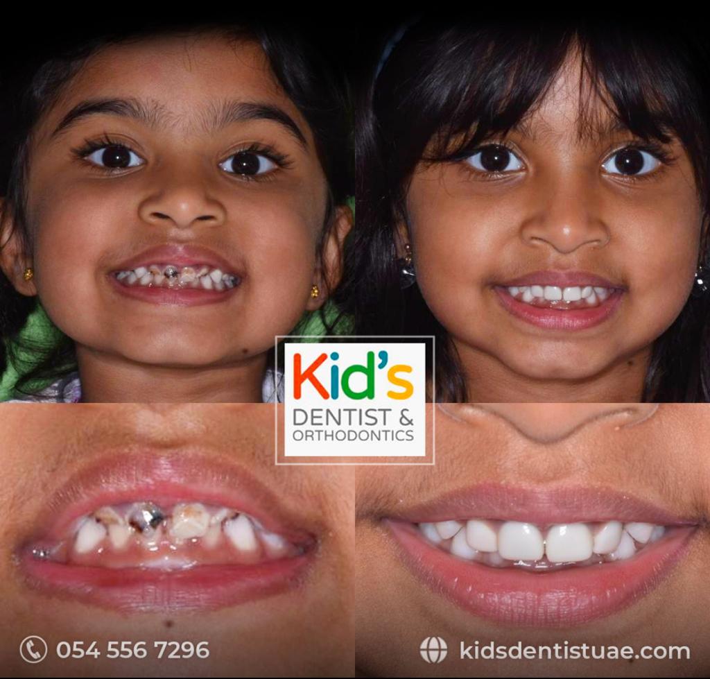 Pediatric Dentist in Dubai - Best Kids Dentist in Dubai - Dr. Suhel ...